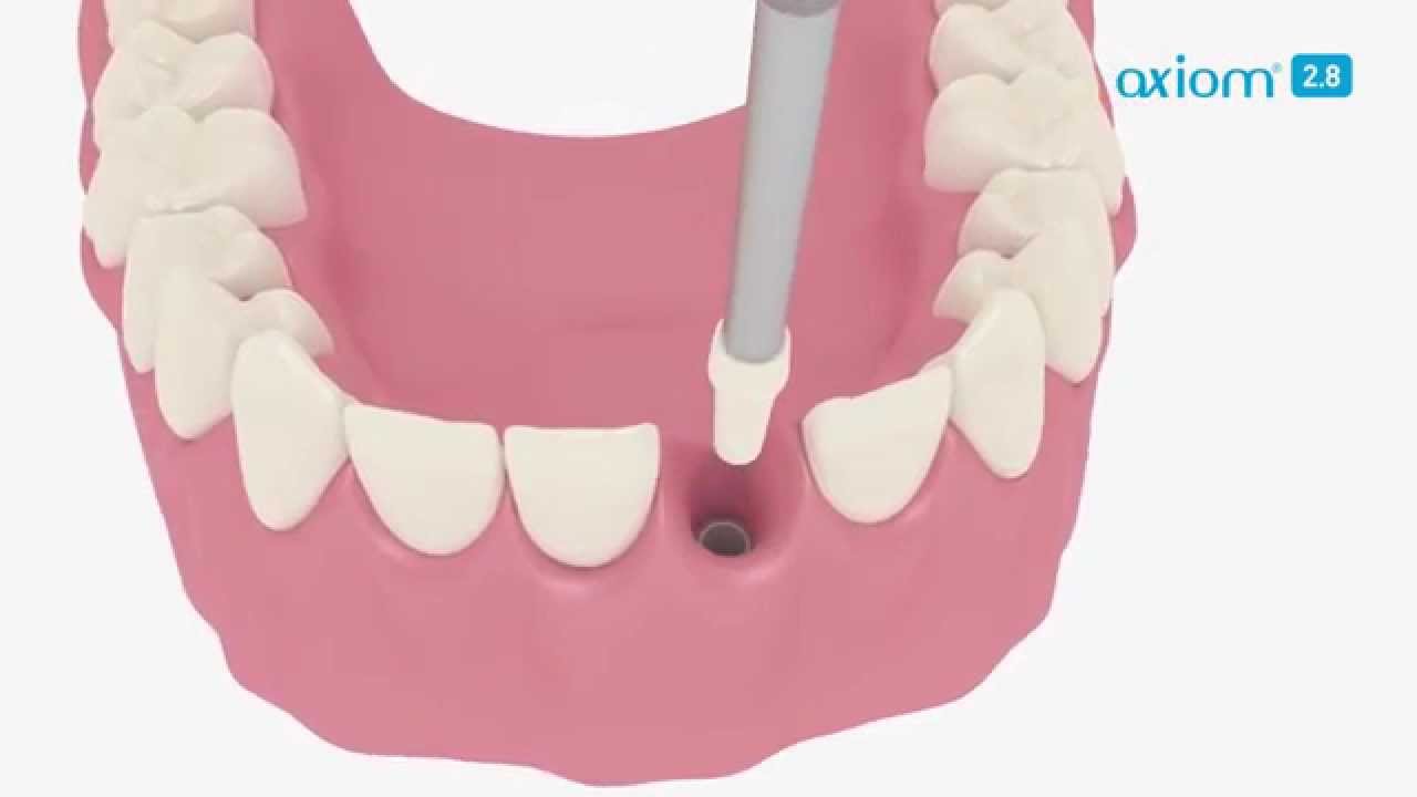 Anthogyr-Axiom2.8-implantdentaire- FR - YouTube