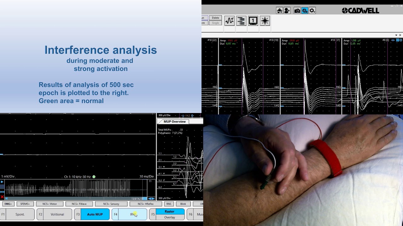 Clinical Demonstration Only Stalberg QEMG - YouTube