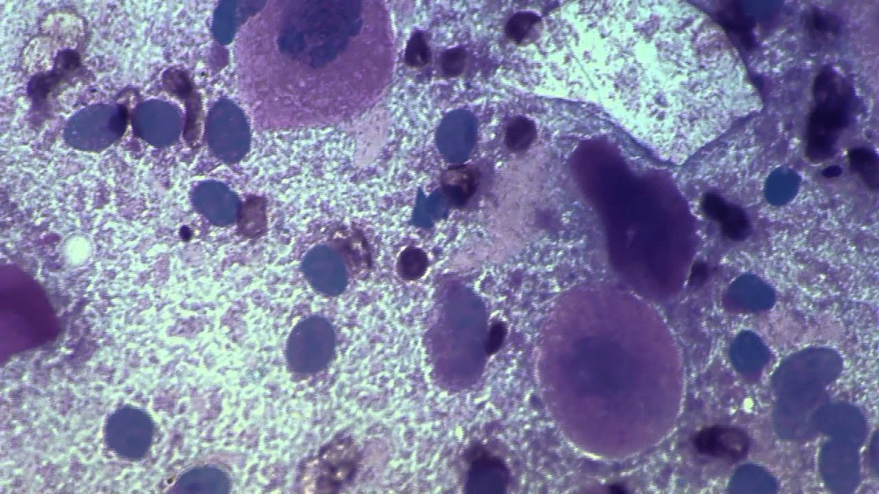 Gyneacology. Kraurosis vulvae. The phenomenon of bare nuclei. - YouTube