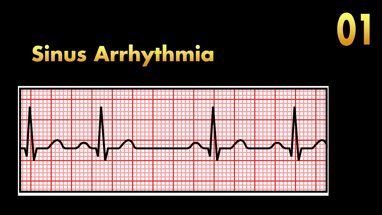 Sinus Arrhythmia: ECG Characteristics, Presentation & Treatment - YouTube