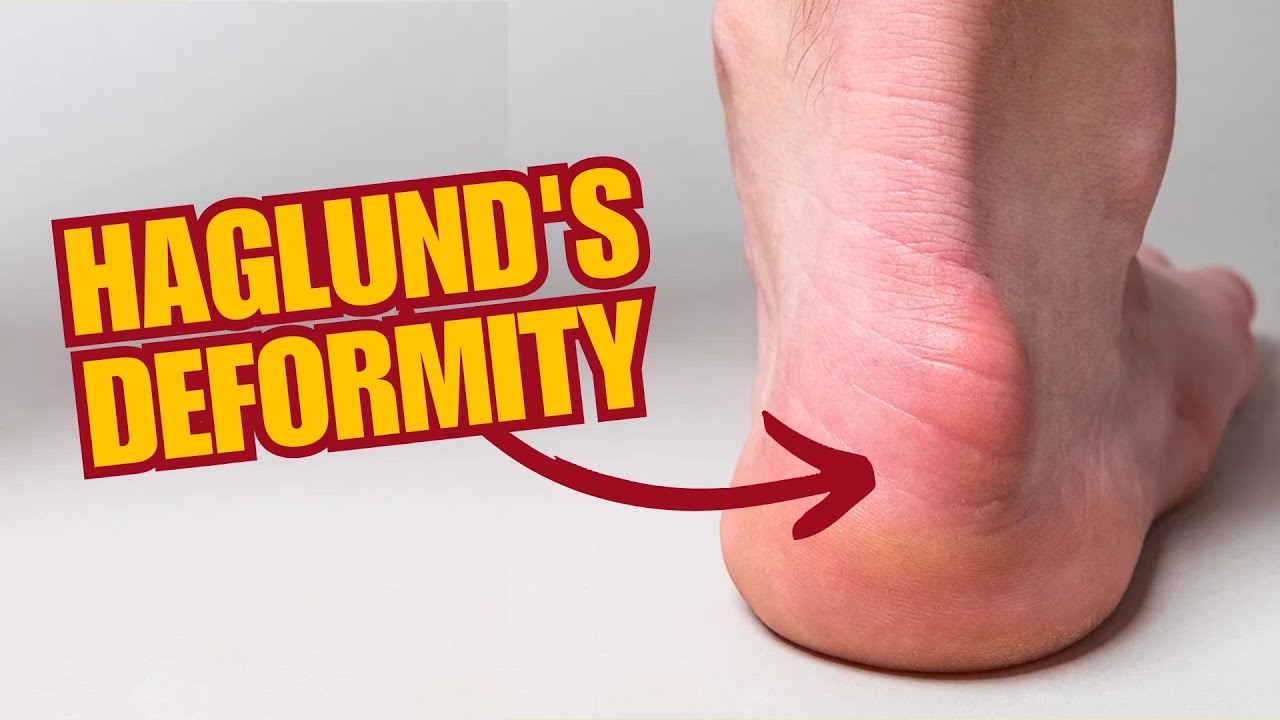 Heel Pain? This Hidden Bone Growth Might Be the Real Cause! 😱 | Haglund ...