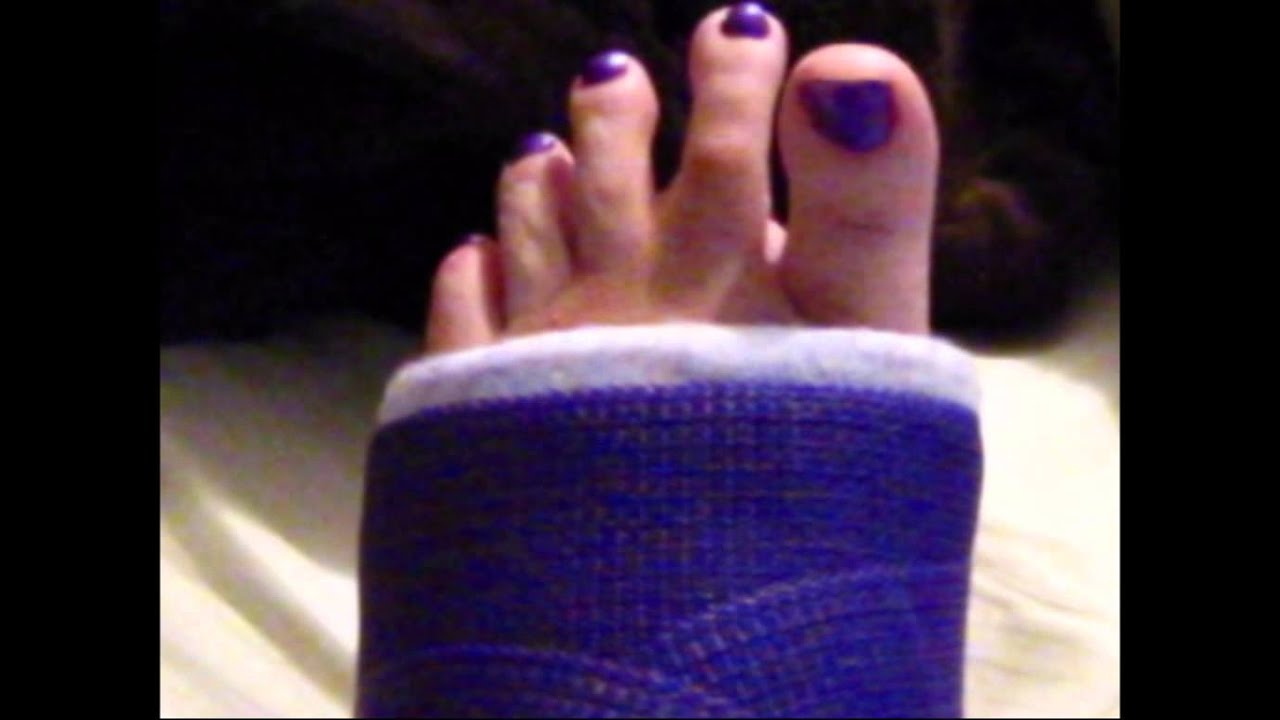 Cast Short Purple Toes 1 - YouTube