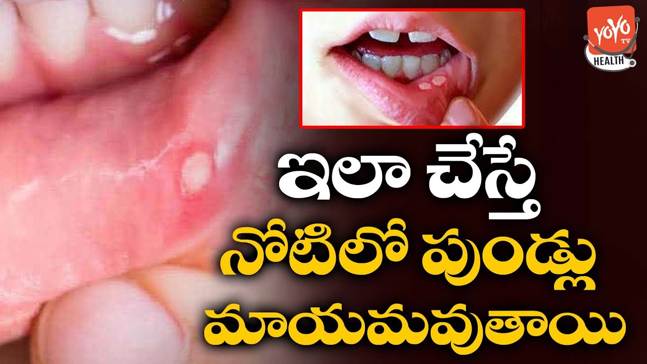 Mouth Ulcer Health Tips | Noti Pootha Tips | Good Health Tips ...