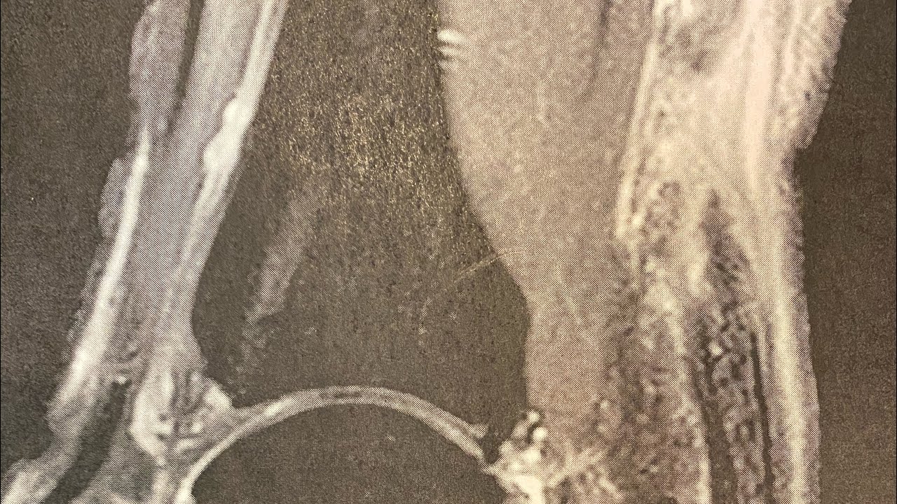 MRI TEST & RESULTS - YouTube