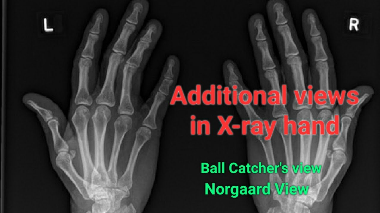 Hand X-ray | Dorsi-Palmar both Hands | Ball Catcher's view | Norgaard ...