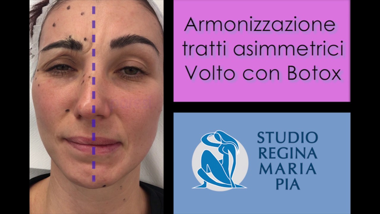 Armonizzazione Tratti Asimmetrici con Botox - YouTube