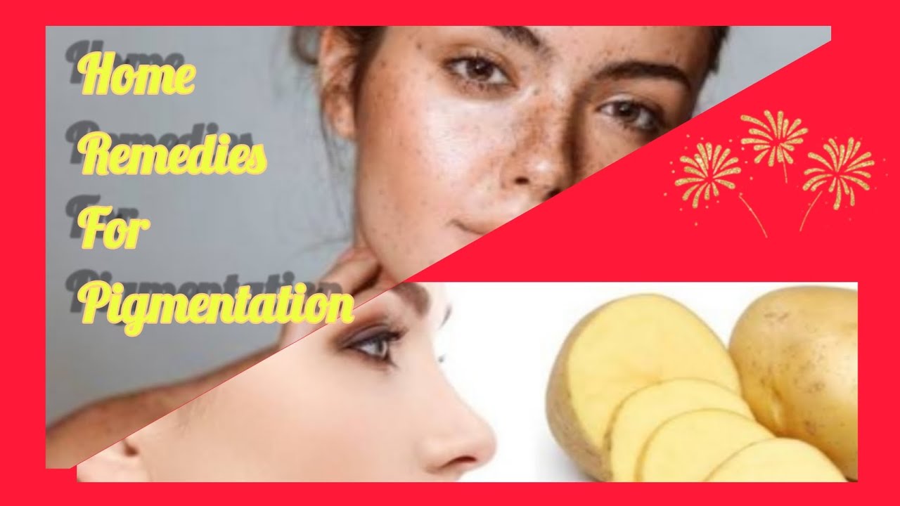 Potato for Dark Spot//মুখে কালচে দাগ দূর করার উপায়।। Home Remedies For ...