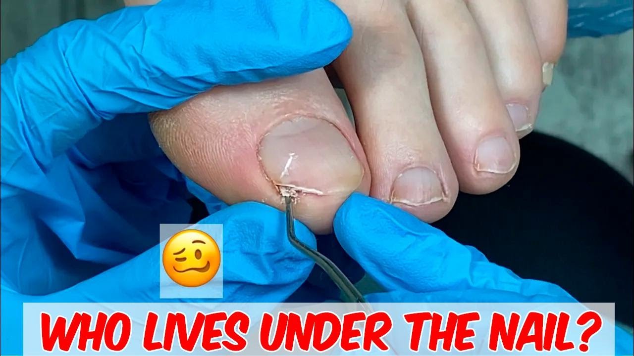 How to Remove a Corn Under Your Toenail 😱 Why Do Toenails on Your Legs ...
