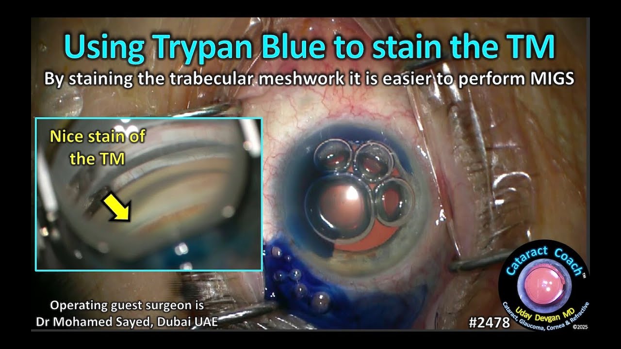 CataractCoach™ 2478: using trypan blue to stain TM trabecular meshwork ...