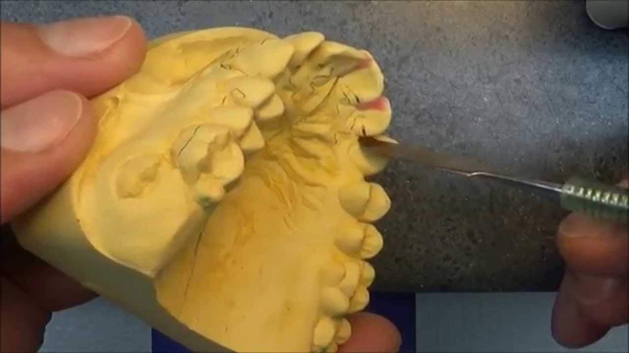 Kieferorthopädie, Orthodontics. Preparing an active plate. Labial bow ...