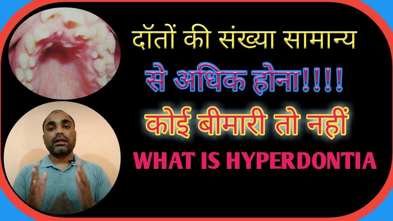 Hyperdontia kya hai|Multiple number of tooth| How to hyperdontia erupt ...