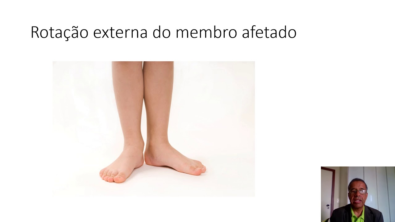 Videoaula Epifisiólise femoral proximal Residentes - YouTube