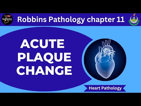 Acute Plaque Change,Heart pathology, Robbins pathology,#pathology # ...