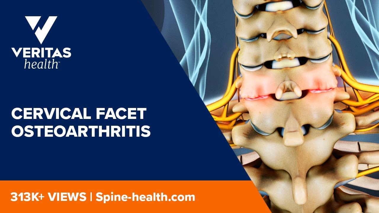 Osteoarthritis Neck Spinal Osteoarthritis Vs. Degenerative Disc