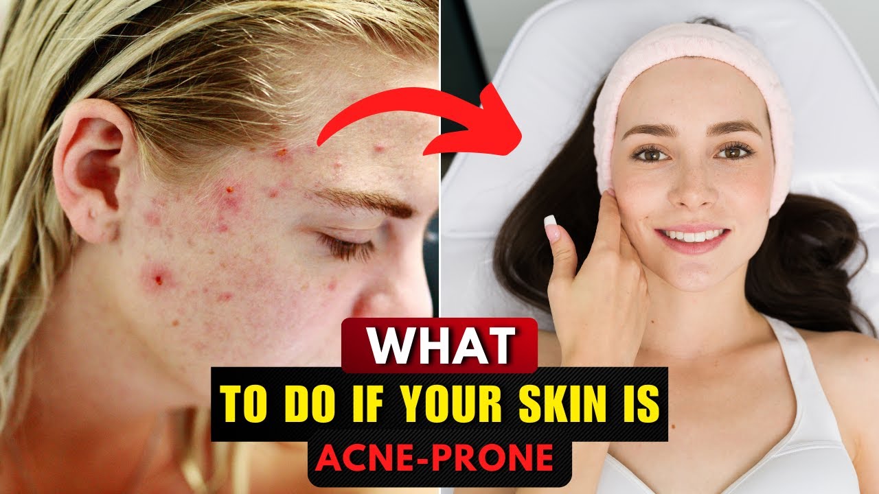 What To Do If Your Skin Is Acne-Prone | Foods You Should Eat & Avoid ...