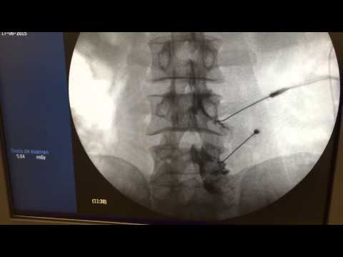 Bloqueo Foraminal Epidural L4-L5 L5-S1 - YouTube