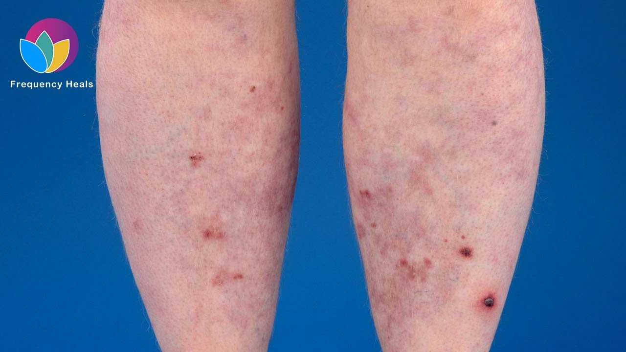 Polyarteritis Nodosa Assist | Reduce Inflammation & Regulate Blood Flow ...