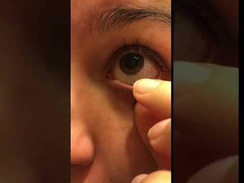 Satisfying Eye String Removal From Eye Allergies - YouTube
