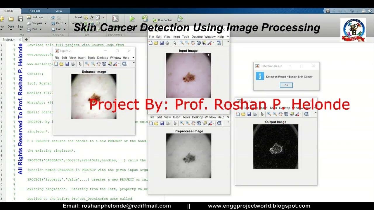 Skin Cancer Detection Using Image Processing Matlab Project With Source Code Skin Cancer ...