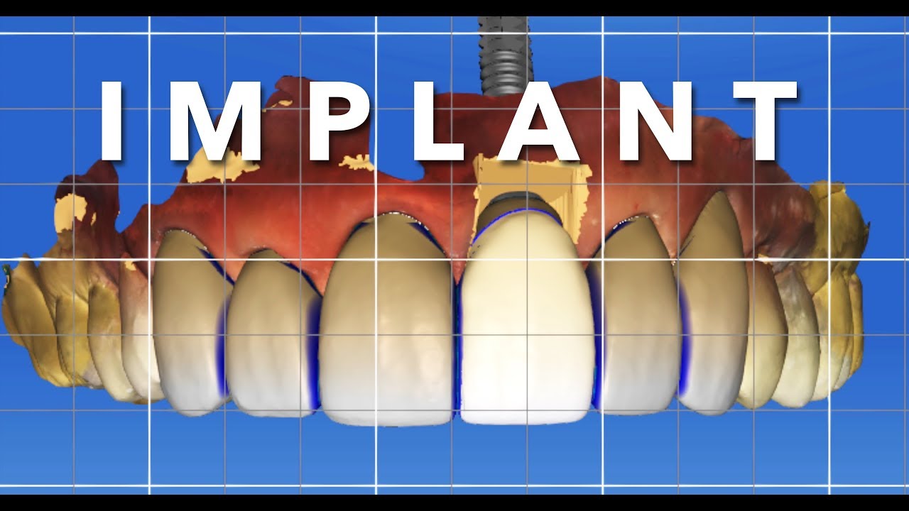 Dental IMPLANT, VENEERS, CROWNS - 3D Computer Guided Cosmetic Dentistry ...