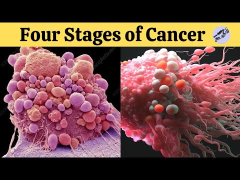 Stage of Cancer | 4th Stage - Metastatic | Advanced Cancer | Biology ...
