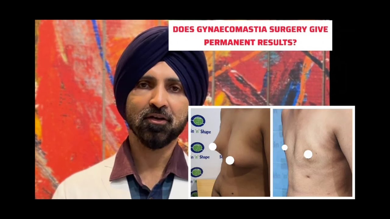 Gynecomastia Correction Surgery in Chandigarh | Dr. HS Bakshi - Skin-n ...