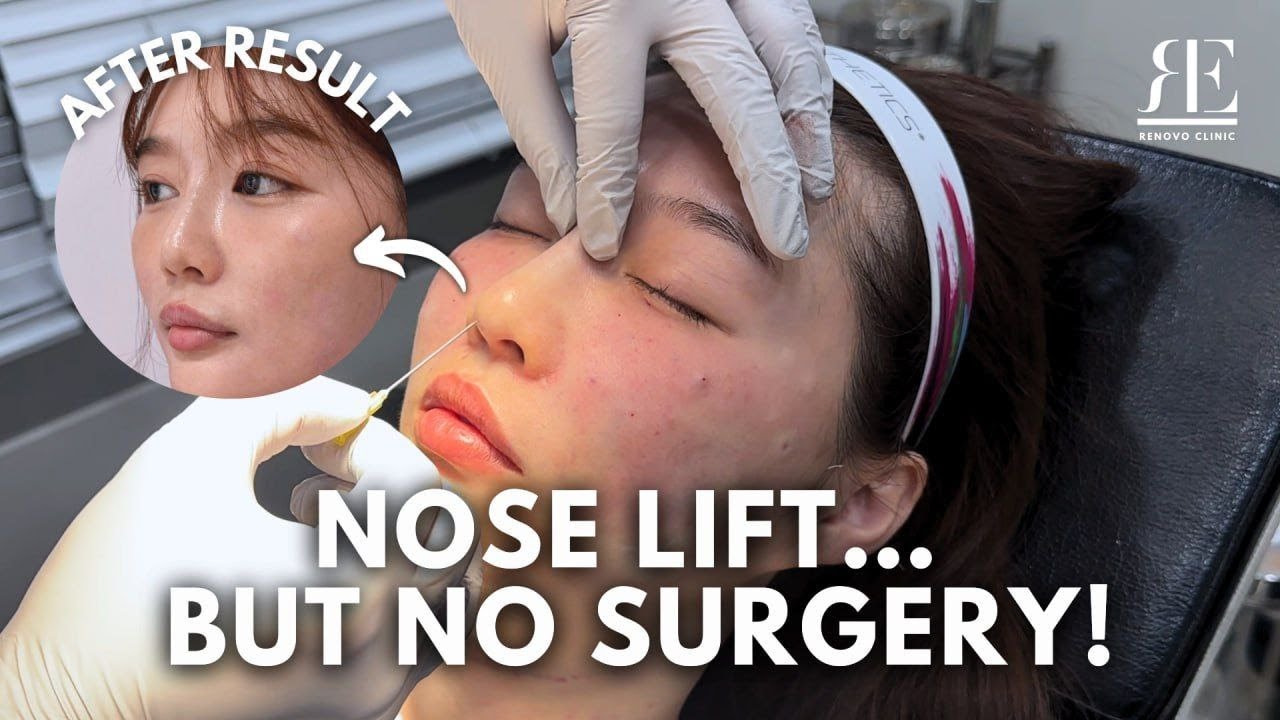 I Tried the HIKO Nose Filler at Renovo | Instant Nose Lift Without ...