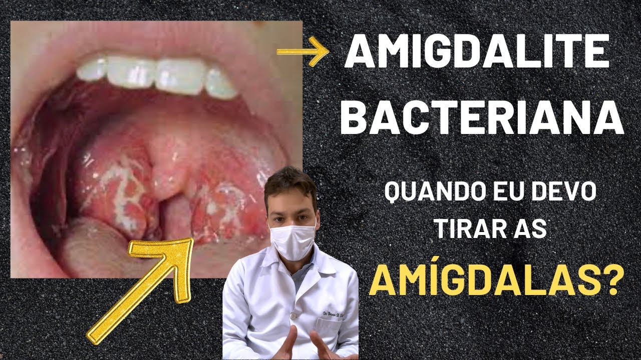 Quando diante de uma infecção de garganta eu devo remover as Amígdalas ...