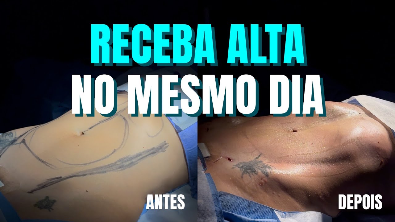 O que é a MINI LIPO? | Dr. Wilian Pires - YouTube