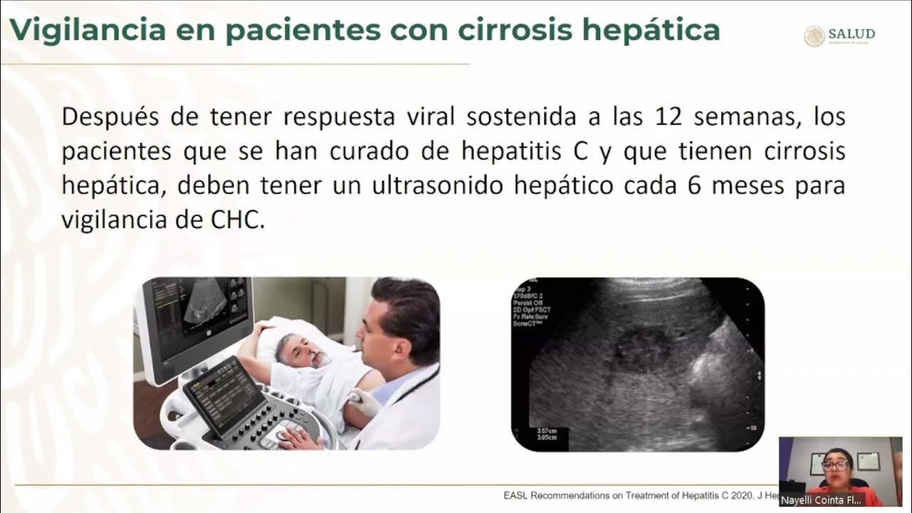 Actualización en el tratamiento de la hepatitis C - YouTube