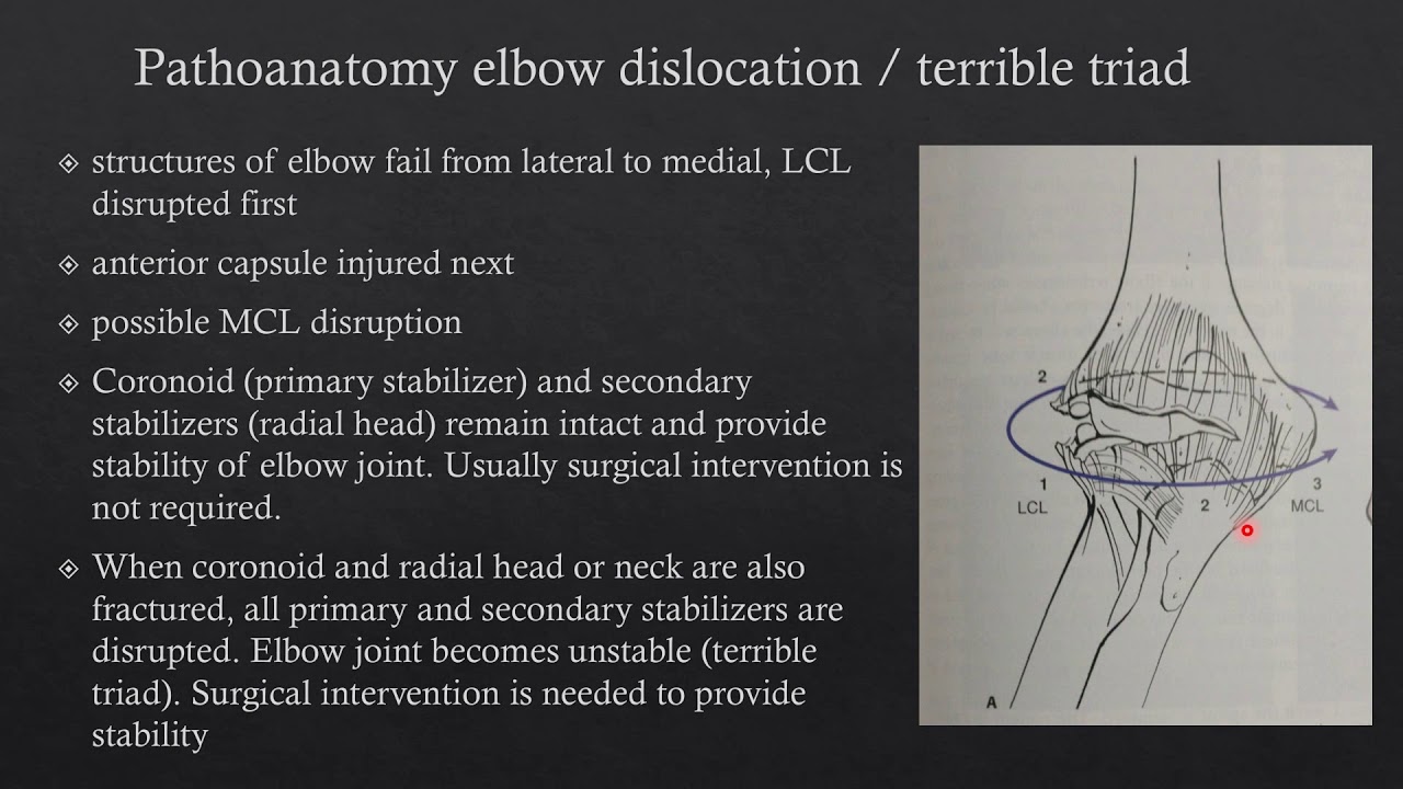 TERRIBLE TRIAD OF ELBOW PART 1 - YouTube