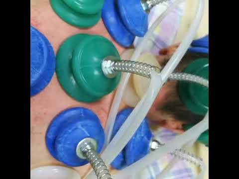 Вакуум градиентную терапия - YouTube