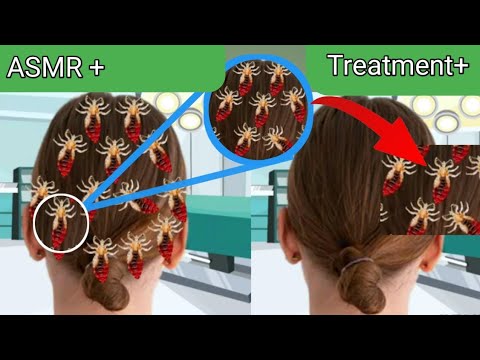 ASMR animation treatment lice and barnacle Infected hair tick - YouTube