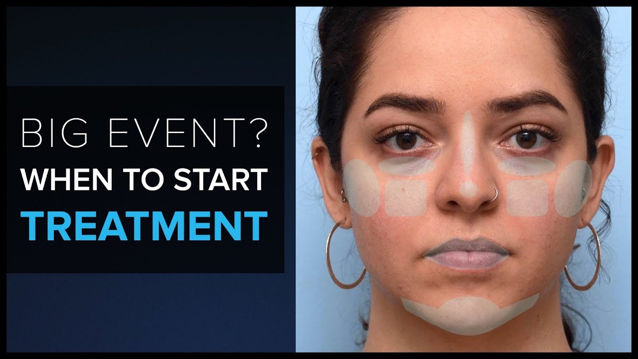 Big Event On the Horizon? When to Start Dermal Filler Treatment? - YouTube