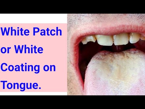 White Patch or White Coating on Tongue.How to Cure White Coating or ...