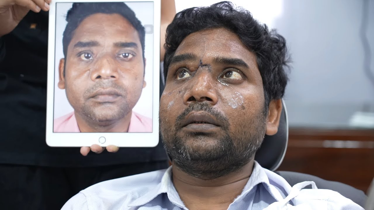 Trauma Rhinoplasty and Reconstruction of Nose - Before and After ...