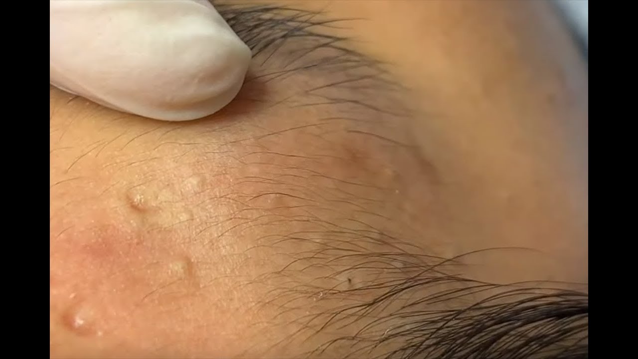 Milia,[𝑨cne Clear Th] How to Removal Blackheads & Whiteheads on Face at ...