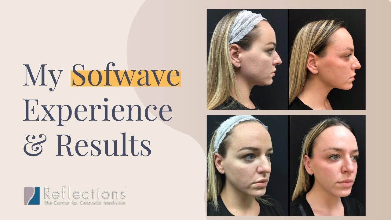 My #Sofwave Experience - "When I put the After next to the Before, the Results were just - WOW ...