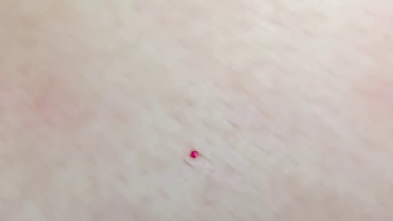 Vasculyse sur point de rubis - YouTube