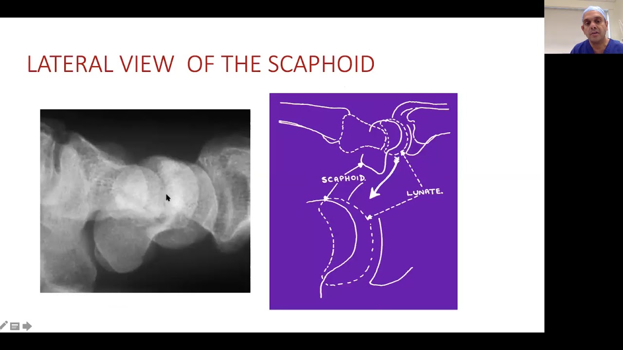 THE SCAPHOID - ANATOMY, RADIOLOGY AND MANAGEMENT ( 2020 via Zoom ...
