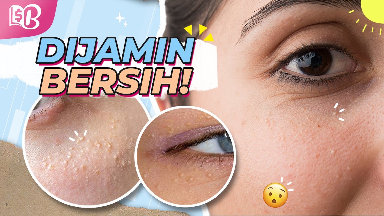 AMPUH! Cara Hilangkan Milia Dengan Cepat, Mudah, dan Aman - YouTube