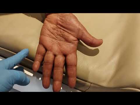 Único pliegue palmar 🧠🧬www.odry-neurogenetica.com - YouTube