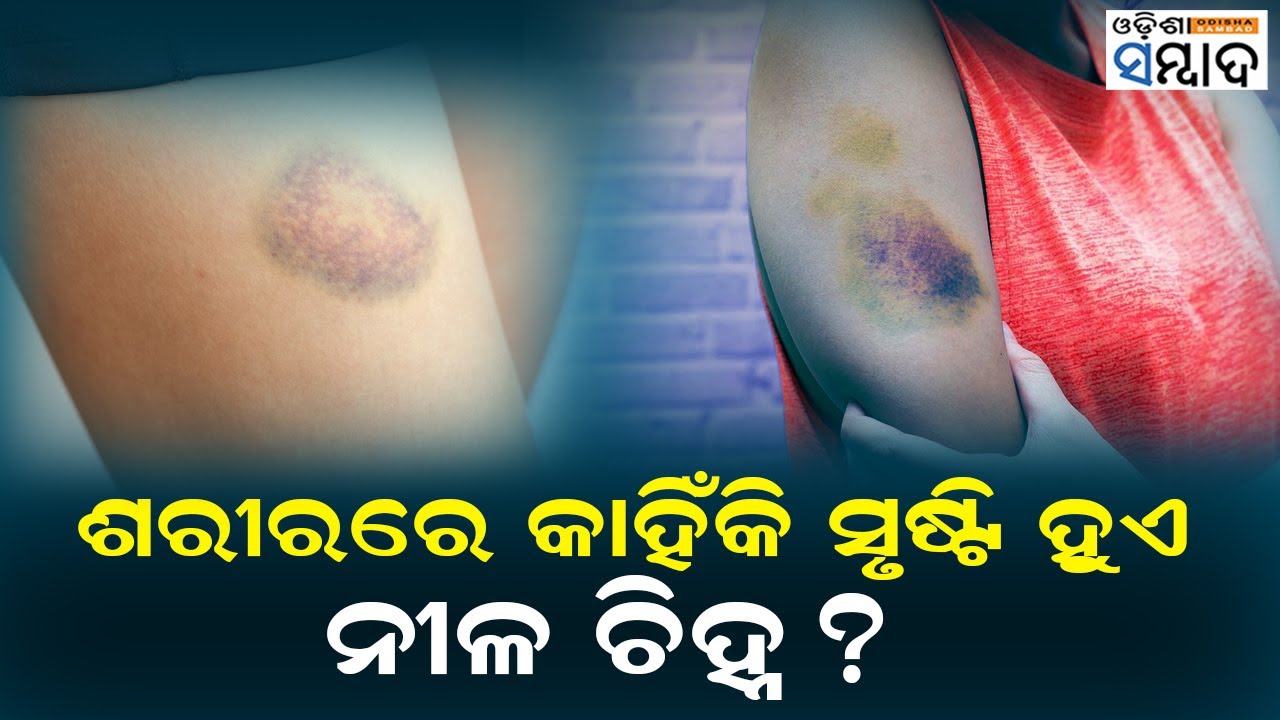 Why Blue Marks Appear on Body - YouTube