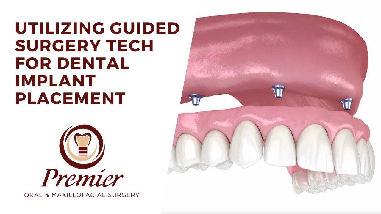 Utilizing Guided Surgery Technology for Dental Implant Placement - YouTube