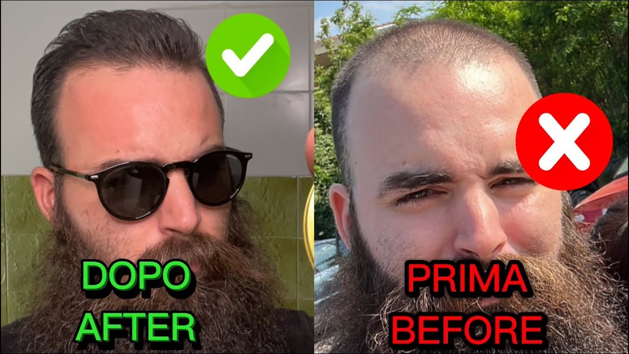 CADUTA CAPELLI E TRATTAMENTO CALVIZIE BIOTRIKOS #hairloss # ...