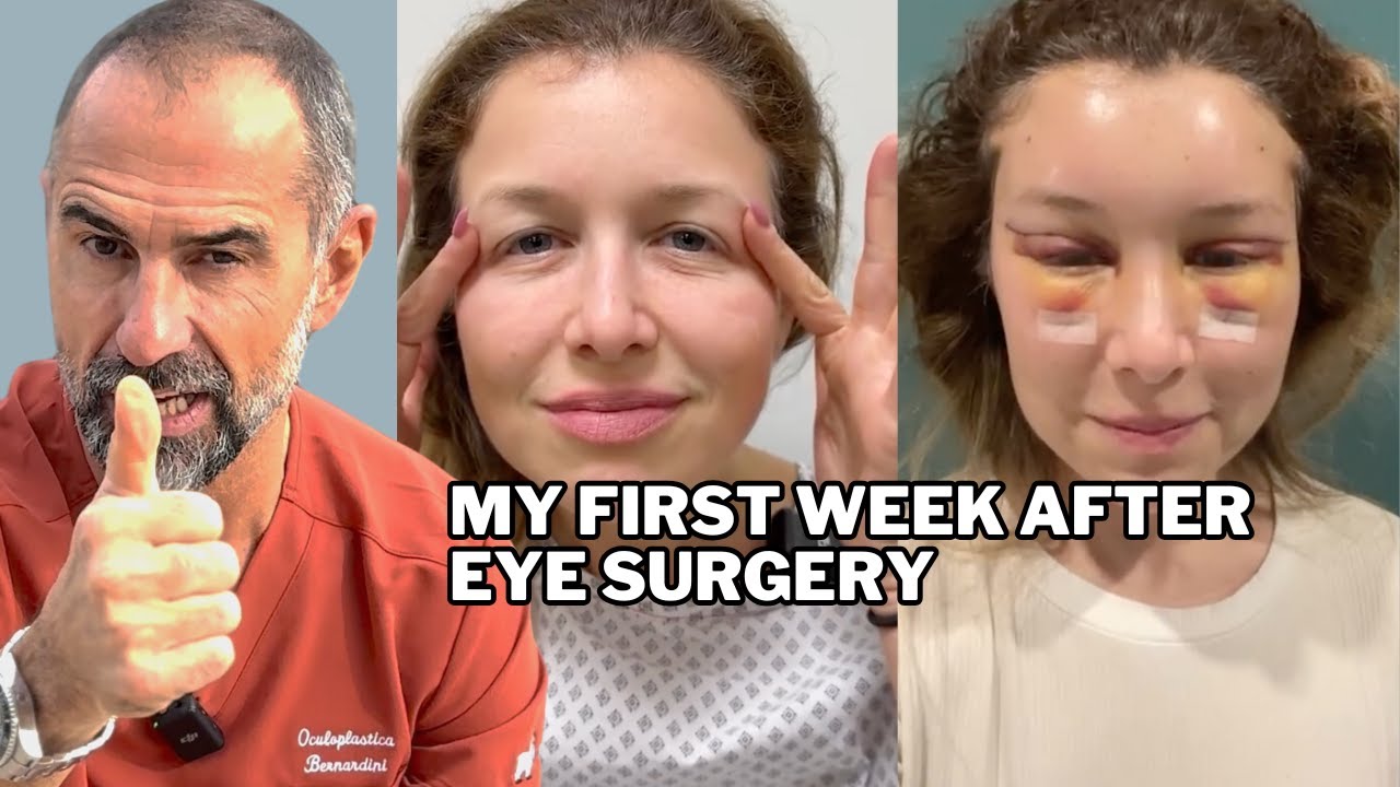 My First Week After Eye Surgery: Real‑Time Recovery Diary & Essential ...
