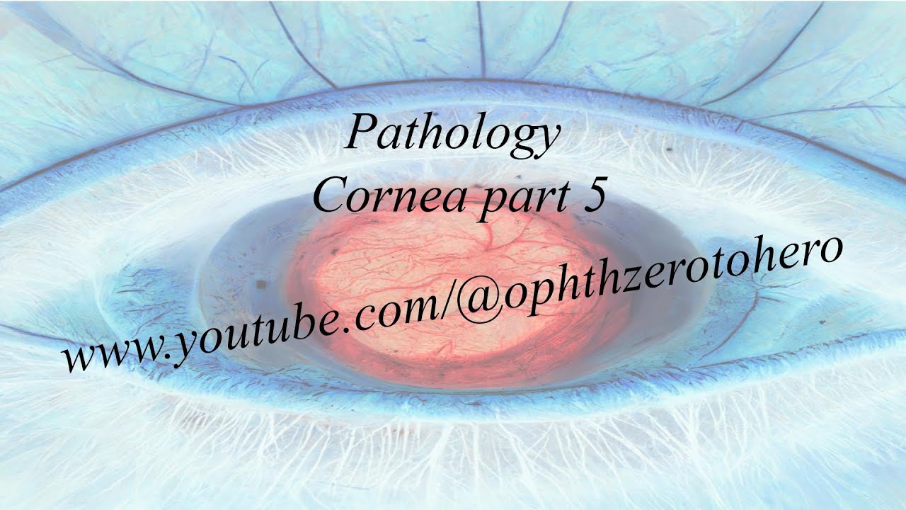 Dr.Elkafrawy Pathology Cornea part-5 (Other Corneal Depositions) - YouTube