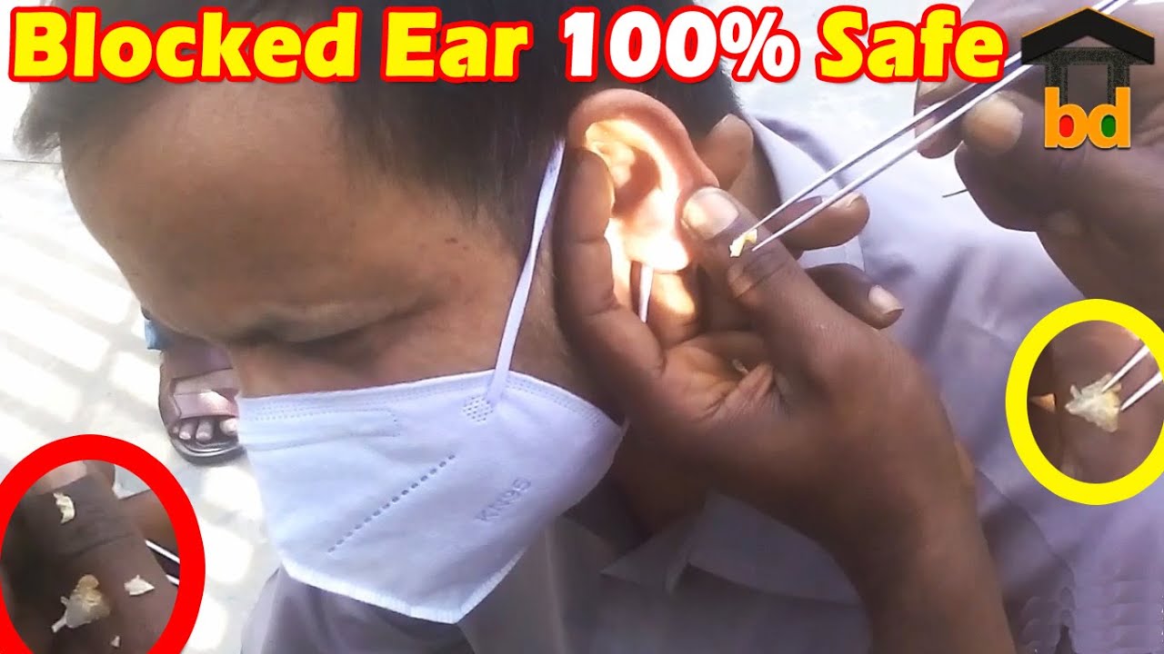Large & Huge Chunky White Earwax Removal (Absolutely Big Deal) II Best ...