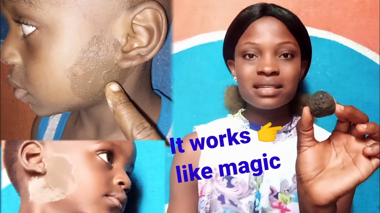 #mumps, How to cure Mumps at home fast. this is what I use to treat ...