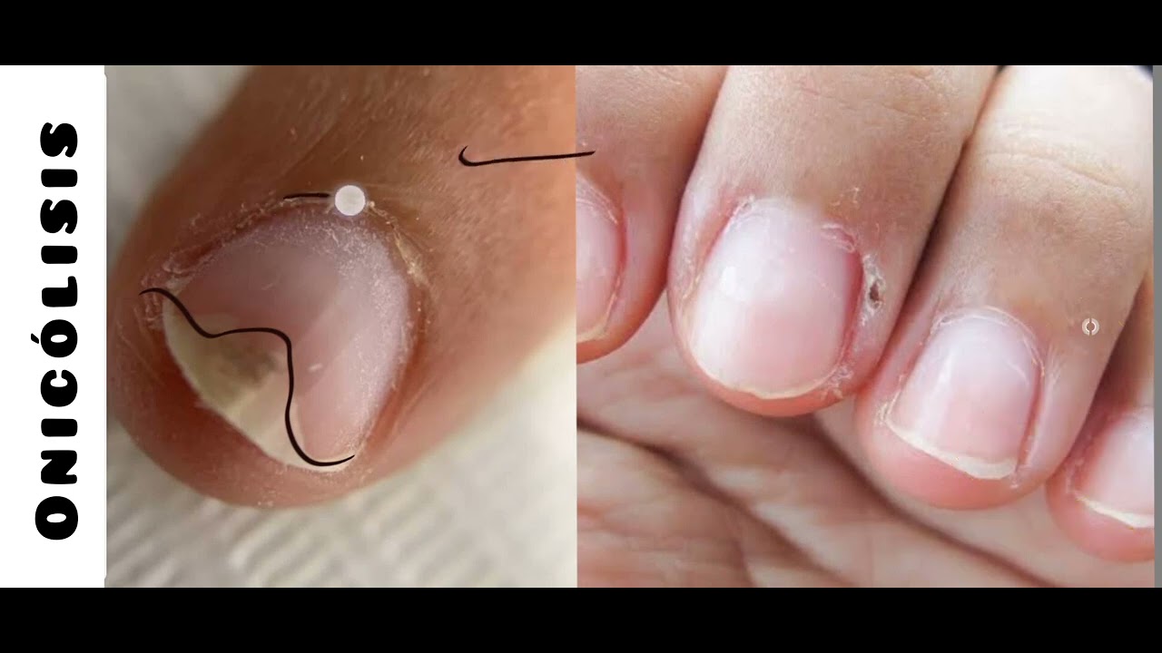 Onicólisis en uñas de las manos #nails #uñas #enfermedades - YouTube